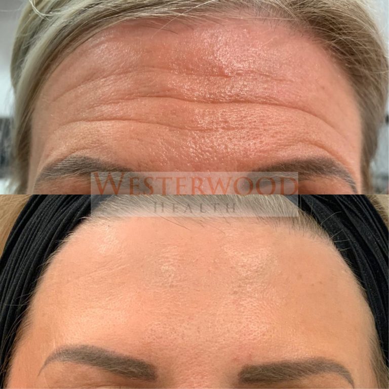 forehead wrinkles | Westerwood Health Clinic