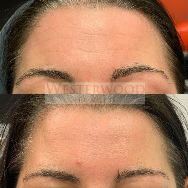 forehead wrinkle before after | Westerwood Health Clinic