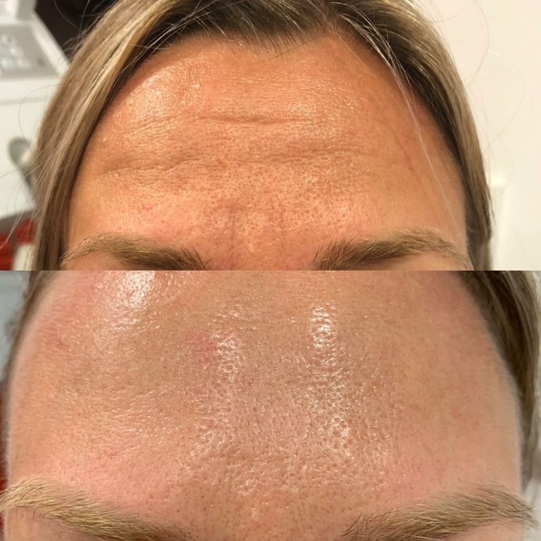 botox forehead lines | Westerwood Health Clinic