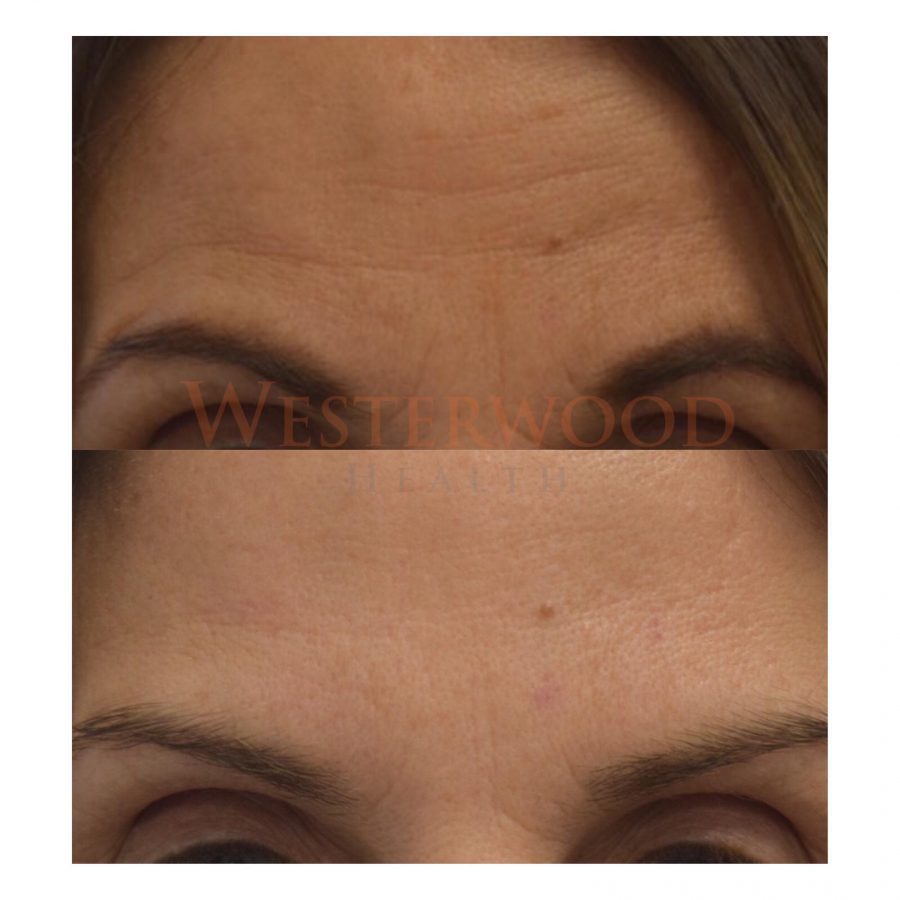 clear forehead botox | Westerwood Health Clinic