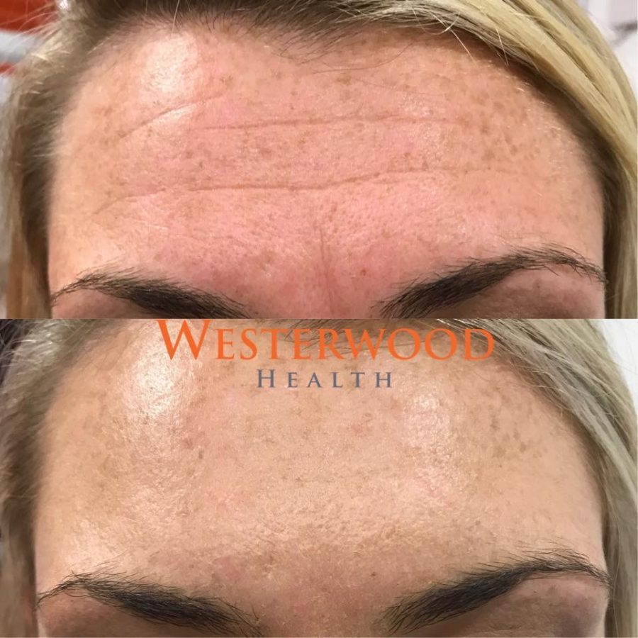 acne wrinkles skin botox | Westerwood Health Clinic
