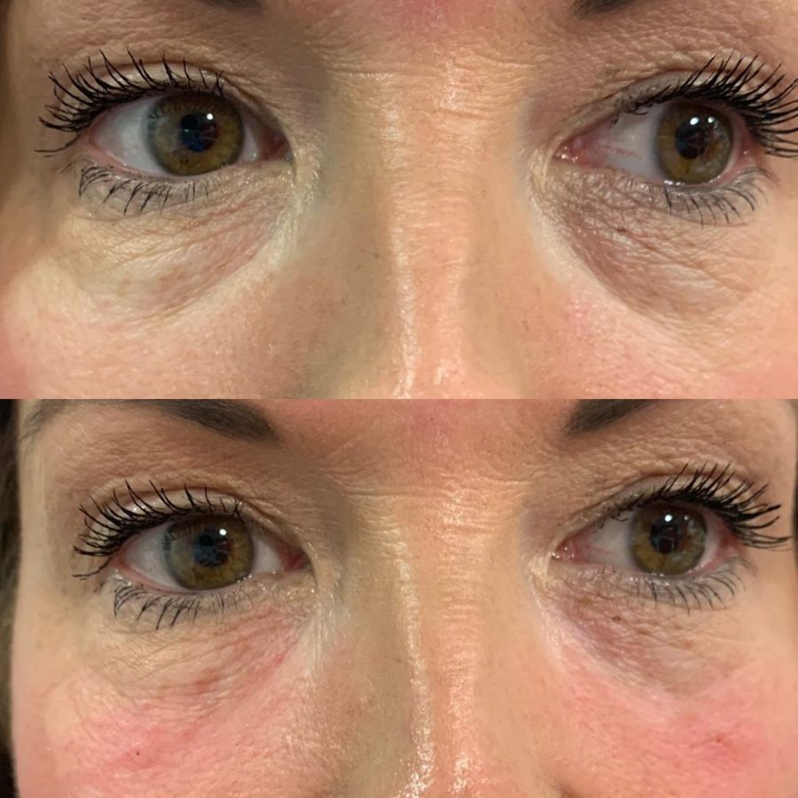 Droopy eye lids | Westerwood Health Clinic